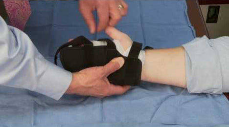 Hely & Weber Xtender Dupuytren's Contracture Splint